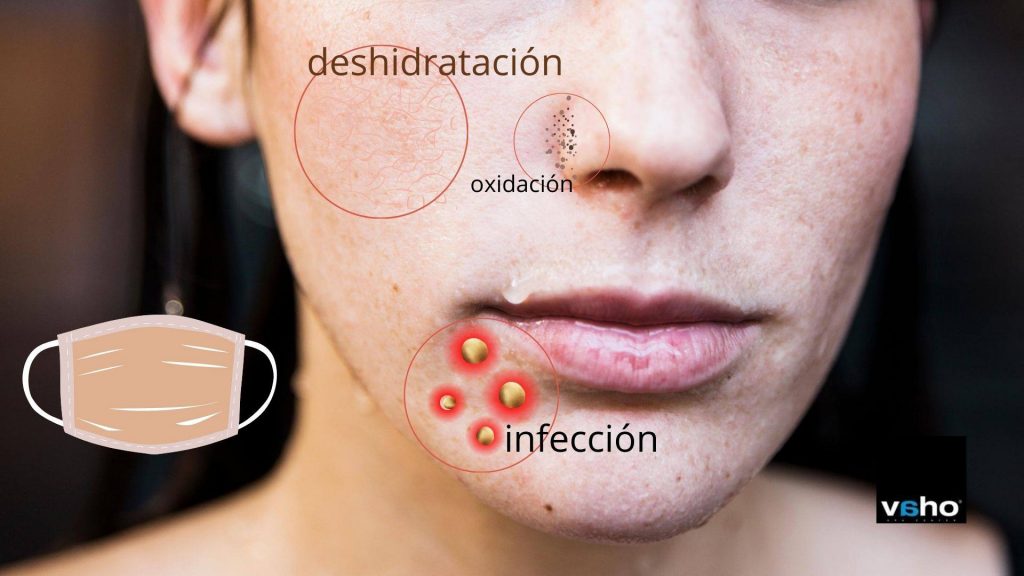 ¿La mascarilla provoca acné? - Vaho Spa Center
